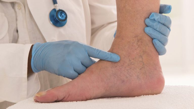 Spataderen: Wat zijn dat eigenlijk? • Hilhorst Hulpmiddelen